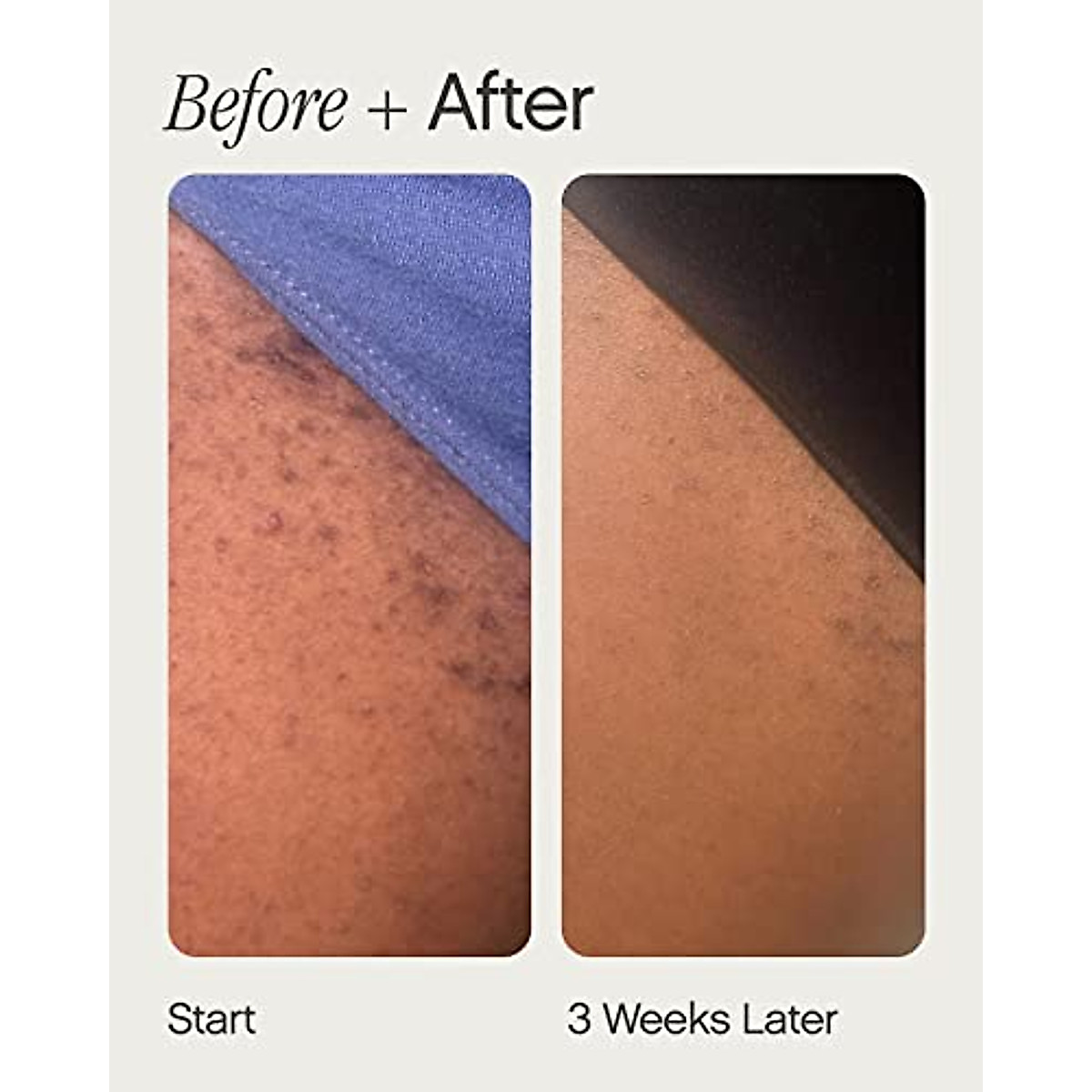 Topicals High Roller Ingrown Hair Serum | Roll-on Tonic to Soothe and Calm Irritated Skin on Face, Armpits and Bikini Areas | Contains Salicylic and Glycolic Acid | Vegan and Cruelty-Free (1.7 Fl Oz)