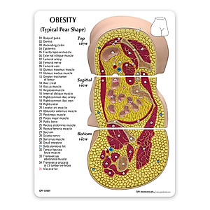 Obesity Model | Human Body Anatomy Replica of Overweight Body Types for Doctors Office Educational Tool | GPI Anatomicals