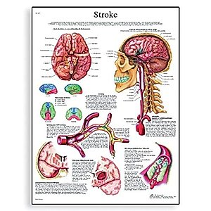 3B Scientific VR1627L Glossy Laminated Paper Stroke Anatomical Chart, Poster Size 20" Width x 26" Height