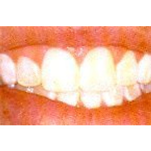 D.I.Y)10 Thermo-molding "BOIL and BITE" Mouth Trays by Instant White Smile Wholesale
