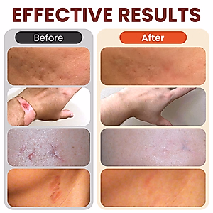 e70 Intensive Healing Scar Cream - Fast Repair Surgical Scars, C-Section, Stretch Marks, Keloids, Burns, Old & New Scars. Vitamins Full - All Skin Types - Reduce Acne Spots Appearance - 2.0 Fl Oz