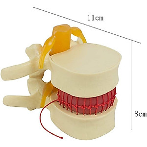 1PCS Anatomical Human Lumbar Vertebrae Degenerative Lumbar Human Spine Model (Yellow)