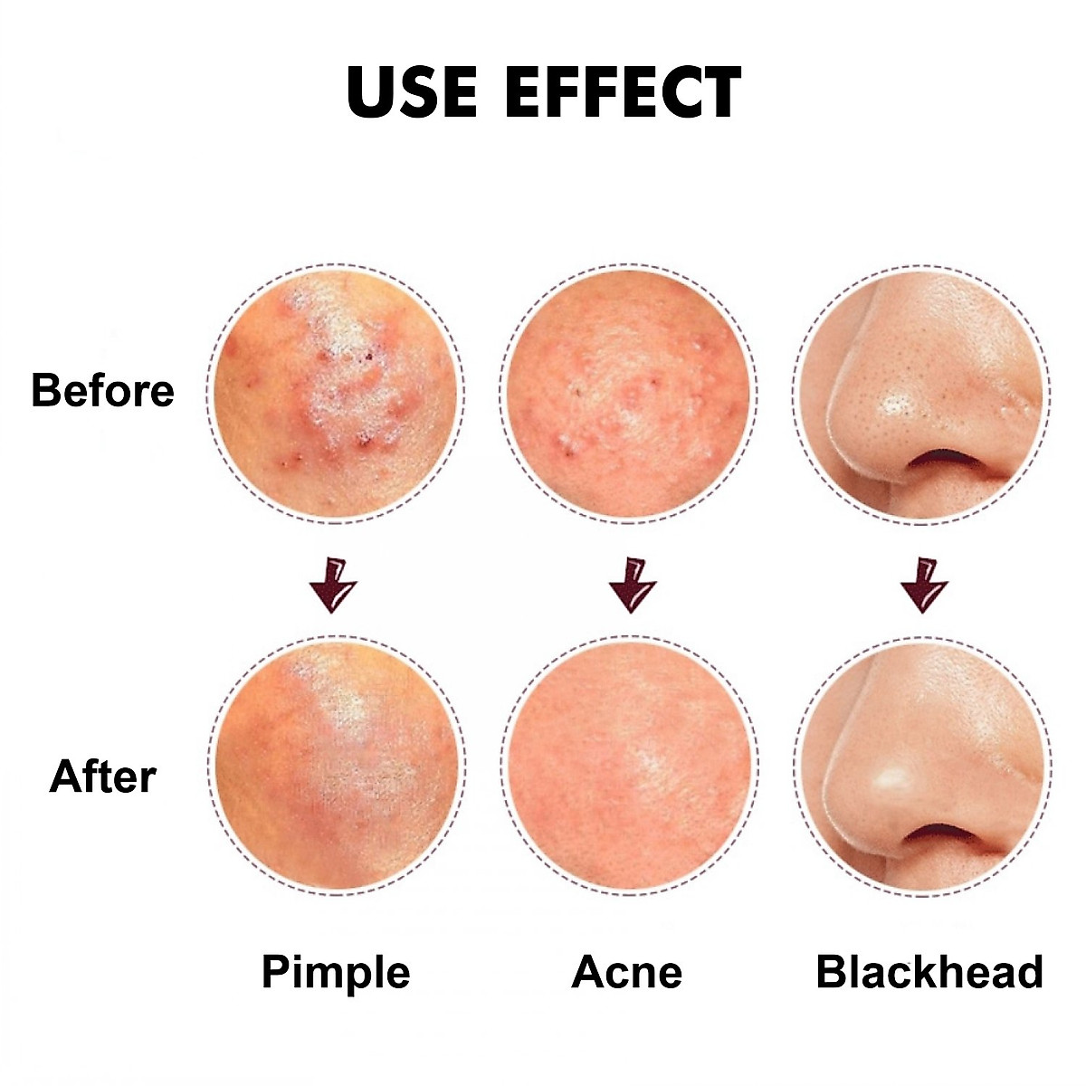 FIXBODY Blackhead and Splinter Remover Tools - Stainless Steel Professional Easily Cure Pimples Whiteheads Comedones Acne Zit Ingrown Hairs and Facial Impurities Bend Head Tweezer Surgical Kit