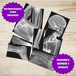 Roylco Broken Bones X-Rays – 15 Realistic Fracture Images for STEM/STEAM Learning, Classroom Anatomy, Health Education, and Labs – Perfect for Teachers, Parents, and Medical Training