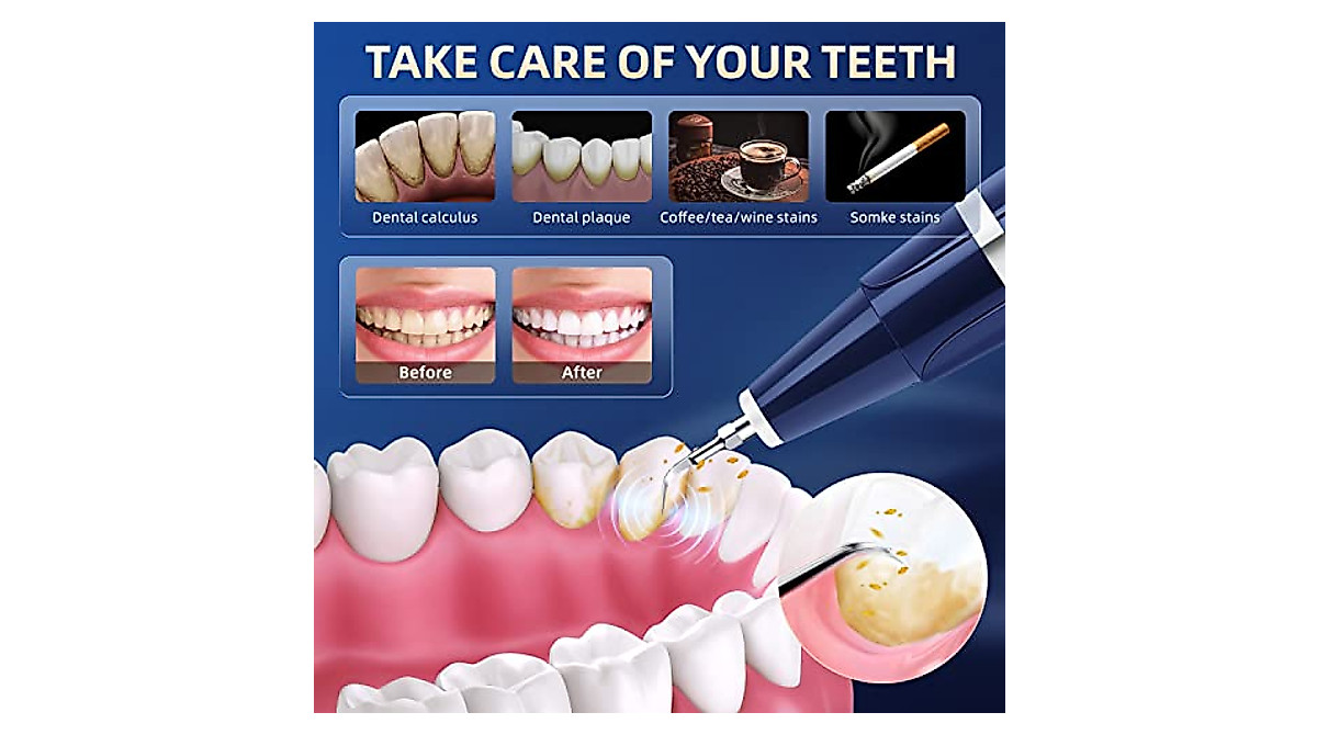 Plaque Remover for Teeth - Effective Tartar & Plaque Removal Kit