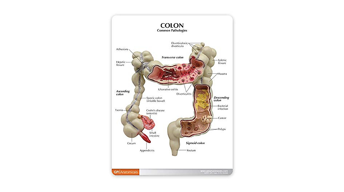 Colon Model for Patient Education - GPI Anatomicals