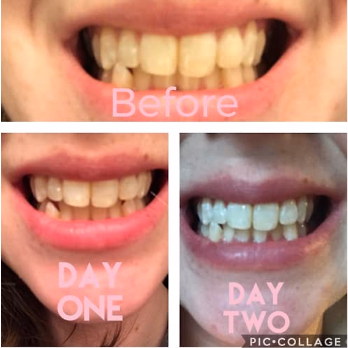 Smile Titan Teeth Whitening Kit, Teeth Whitening Gel (4) with 5X LED Accelerator Light and Tray Teeth Whitener