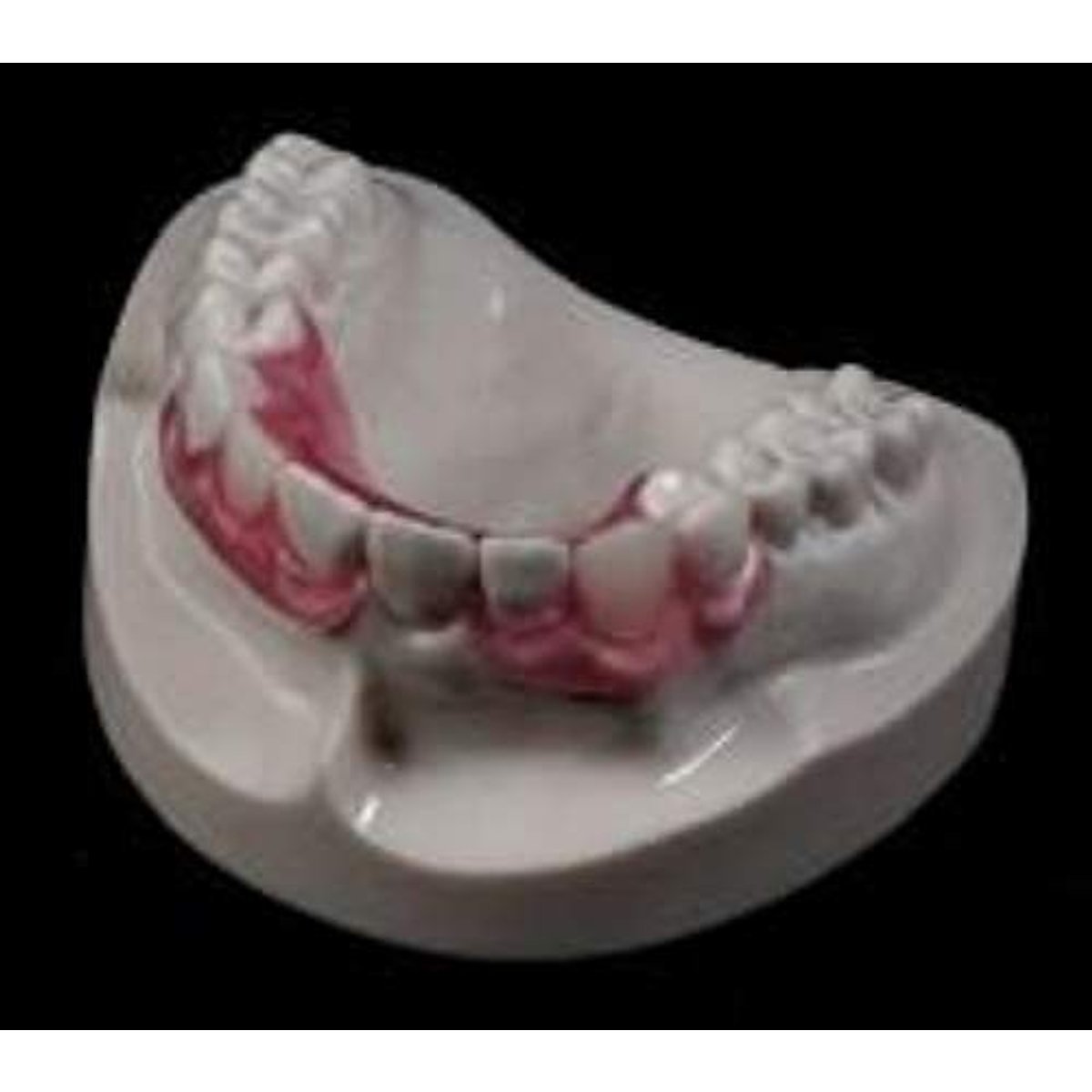 "Nesbit bridge" , Flipper Uppler and Lower Set of Affordability Flexible Valplast Customized Partial Denture (Pink, Valplast)