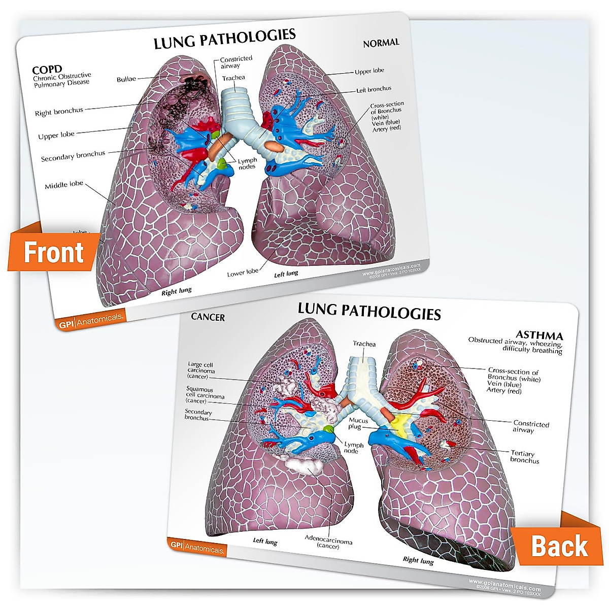 Lung Model Set | Human Body Anatomy Replica of Lung Cancer for Doctors Office Educational Tool | GPI Anatomicals