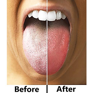 Tongue Scraper Cleaner (2 Pack) Medical Surgical Grade Stainless Steel Metal Tongue Brush Dental Kit Eliminate Bad Breath with Tongue Sweeper Ayurvedic for Daily Oral Dental Hygiene Fresh Breath