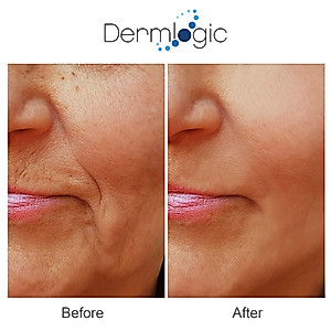 Anti Aging Resurfacing Peel Pads- Triple Action Chemical Peel Pads Combined with Glycolic, Lactic, and Salicylic Acids. Smooth’s Fine Lines, Wrinkles, Dark Spots, and Imperfections to Enhance the Skin