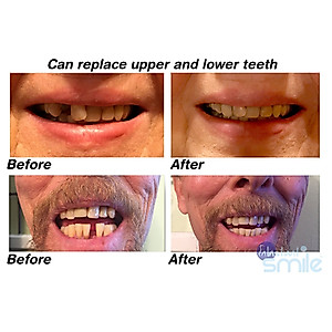 Instant Smile MULTISHADE Patented Temporary Tooth Repair Kit. A Realistic Looking Fix for a Missing or Broken Tooth.