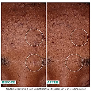 Urban Skin Rx HyperCorrect Intense Fading Cream | Formulated with 5% Cysteamine & 1% Niacinamide | Pre-Cleanse Treatment Improves the Appearance of Post-Acne Scars and Uneven Skin Tone, 1.7 fl oz