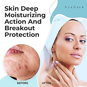 Moisturizing Acne Treatment Cream, Salicylic Acid Face Moisturizer for Oily & Acne Prone Skin, Pimple, Blackhead, Whitehead, Hormonal, & Cystic Acne Treatment for Men, Women, 90-Day Supply by Ayadara