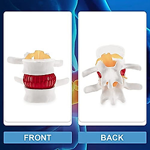 Human Anatomical Lumbar Disc Herniation Model - Lumbar Spine Model for Teaching & Learning - Excellent Way for Demonstrating Disc