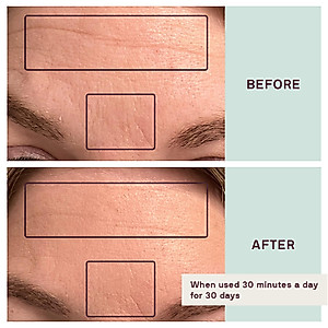 Dermaclara Silicone Facial Patches - Anti-Wrinkle Face Patches for Frown, Smile Lines & Forehead, Reusable Overnight Silicone Wrinkle Pads, Up to 30 Uses - 4 Under Eye Patches & 1 Forehead Patch