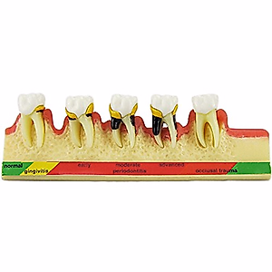Dental Periodontal Disease assort Tooth Teeth Typodont Study Teaching Model New