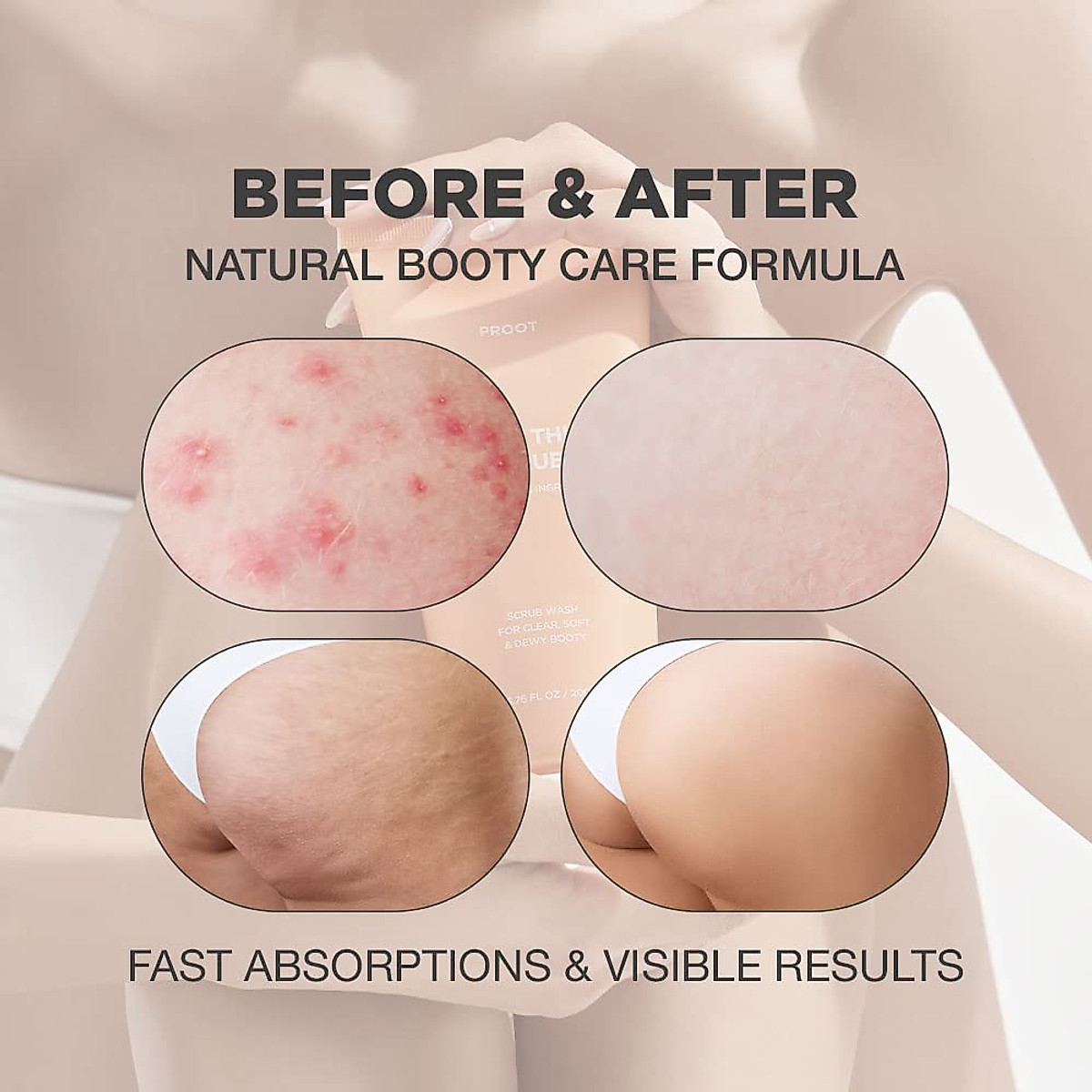 PROOT Butt Acne Spot Treatment Cream (Tube Type) + Butt & Thigh Scrub Wash | Treatment Cream and Booty Scrub for Acne, Cellulite, Ingrown Hair, Bikini & Razor Bump | For all skin type…