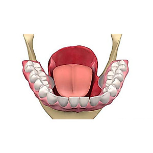 Lower Denture Stabilizers