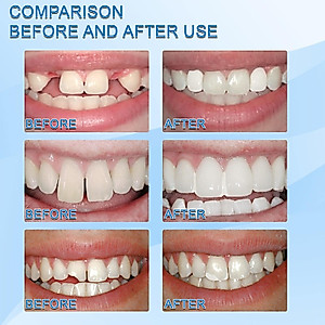 SINGOVE Temporary Tooth Repair kit for Filling The Missing Broken Tooth and Gaps-Moldable Fake Teeth and Thermal Beads Replacement Kit,Artfifical Teeth, Make Smile Confidently (White, One Size)