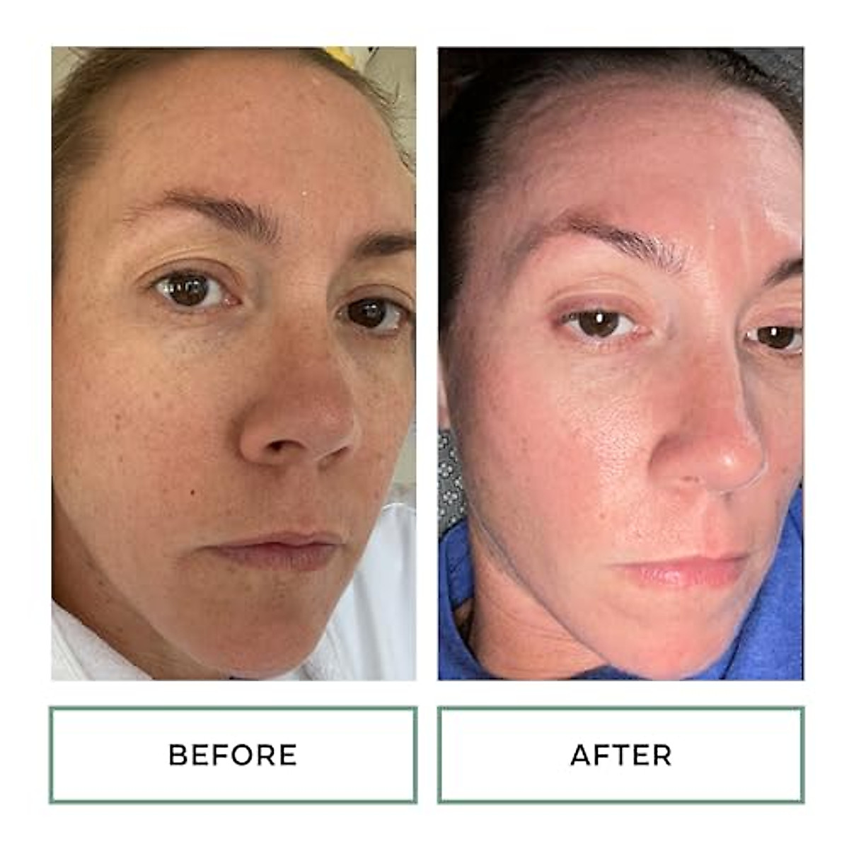 Replenix Glycolic Acid 10% Resurfacing Skin Peel, Medical-Grade Facial Peeling Pads for Discoloration & Acne (60 ct.)