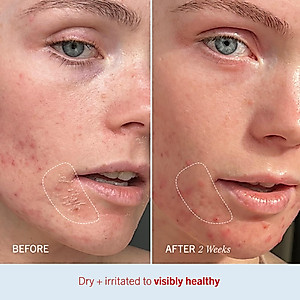 First Aid Beauty - Ultra Repair Cream, Intense Hydration Whipped Colloidal Oatmeal, Clinically Proven to Strengthen Skin Barrier in 7 Days & Helps Relieve Eczema, Luxury Face & Body Moisturizer, 8 oz