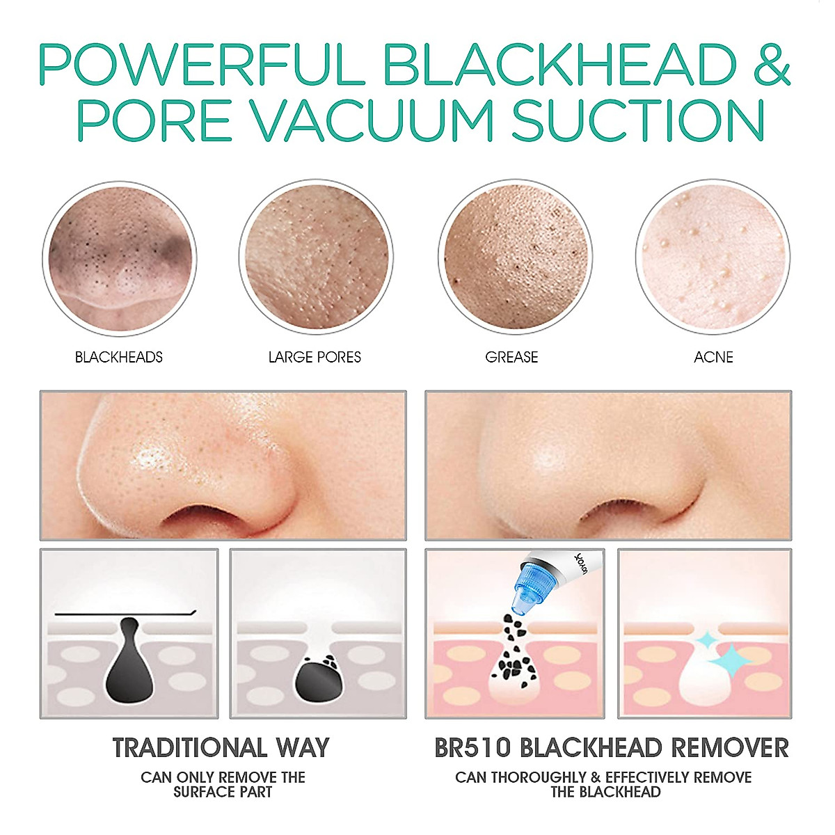 VOYOR Blackhead Remover Pore Vacuum - Electric Face Vacuum Pore Cleaner Acne White Heads Removal with Suction Heads (BR510)
