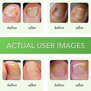 FUNGINIX Fungus Treatment - Toenail, Finger Fungus, and Foot Fungus Solution - Antifungal Spray - Made In the USA - Extra Strength (1 Bottle)