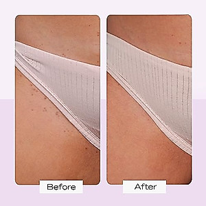 First Aid Beauty Ingrown Hair Pads with BHA & AHA – Daily Treatment Prevents Razor Bumps + Ingrown Hairs and Soothes Irritation – 28 Pads