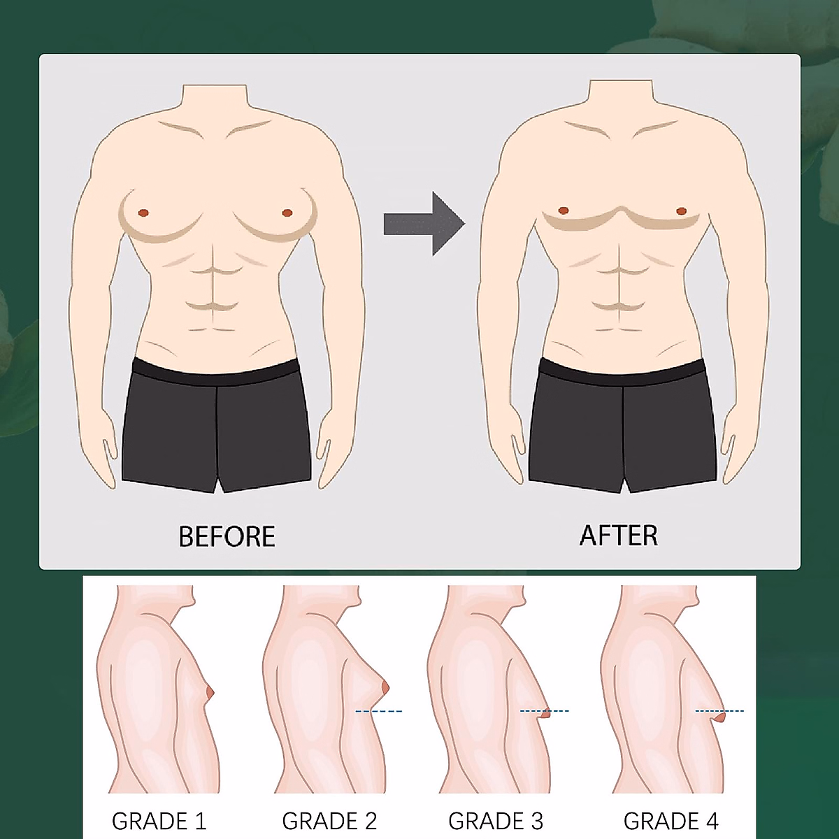 MQSHUHENMY SoliPac Gynecomastia Tightening Ginger Cream, Ginger Cream for Adults, Skin Tightening Cream, Tummy Tightening Cream (3Pcs)