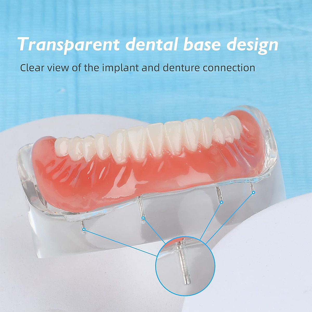 faruijie Overdenture Model - Implant Overdenture Model Lower Denture Model with Four Implants Dental Model Overdenture for Teaching and Studying