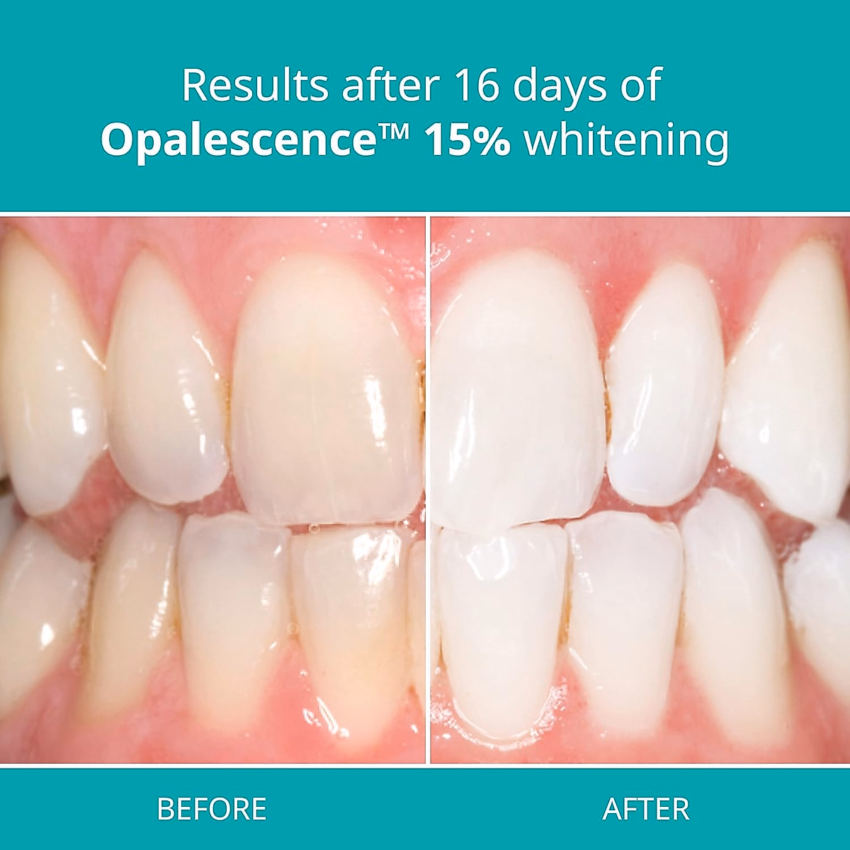 Opalescence 15% Gel Syringes Teeth Whitening Refill Kit - Low Sensivity (2 Packs / 4 Syringes) - Cool Mint - Carbamide Peroxide - Made in The USA by Ultradent Tooth Whitening 5195-2