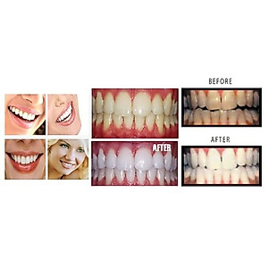5 XL 38% Teeth Whitening Gel Dentist Recommended High Intensity Carbamide Peroxide Pro Dental Lab Direct, Sensitivity Free, Sold by Dentists, Whiter Smile Labs Fast WHITENING Results
