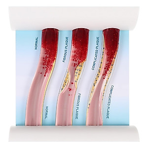 Human Body Skeleton Anatomical Model Low- Density Lipoprotein Blood Vessel Model