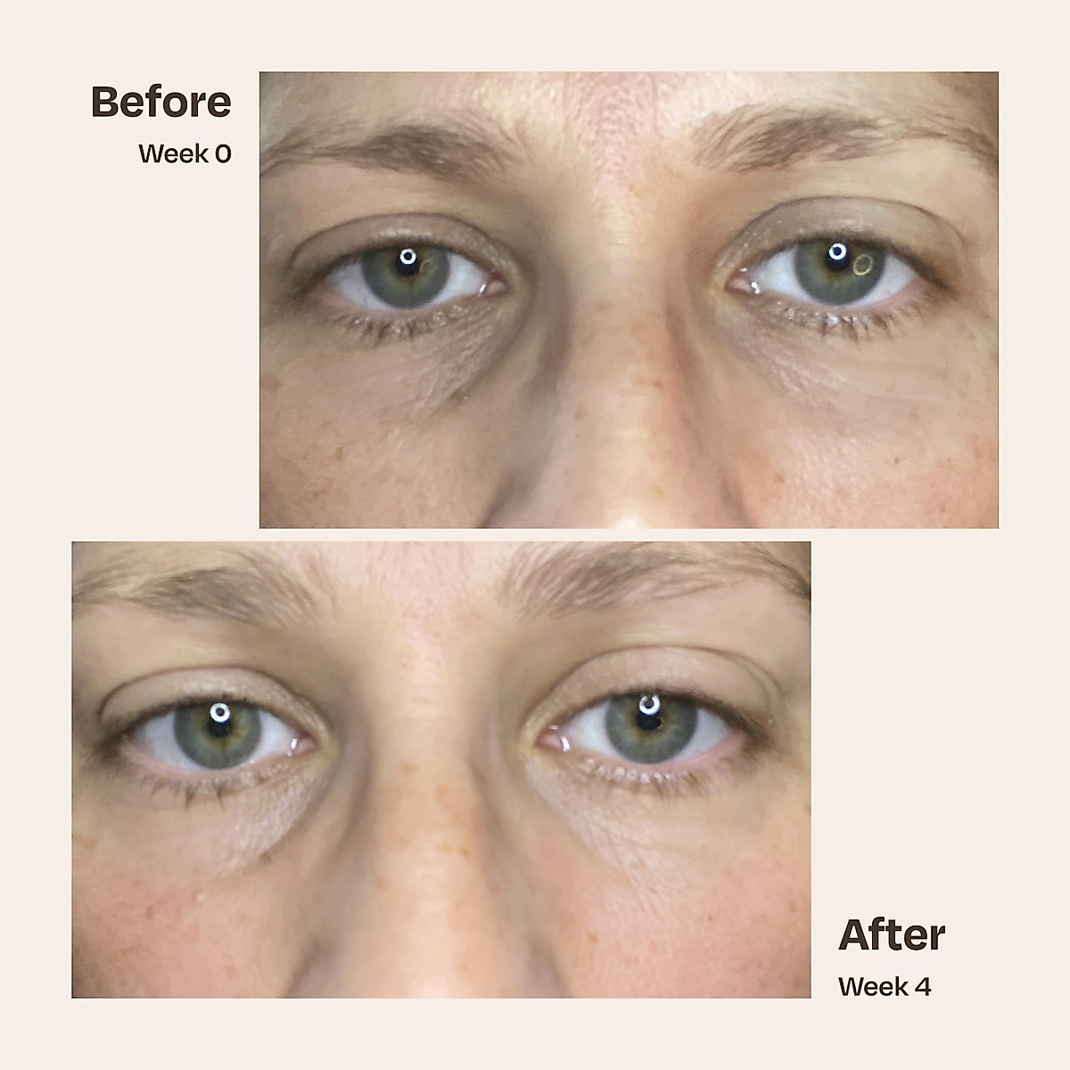 Auria Vita Solo - HomeMicrodermabrasion Machine-Facial Exfoliator Device with Renew Serum - Auria Beauty