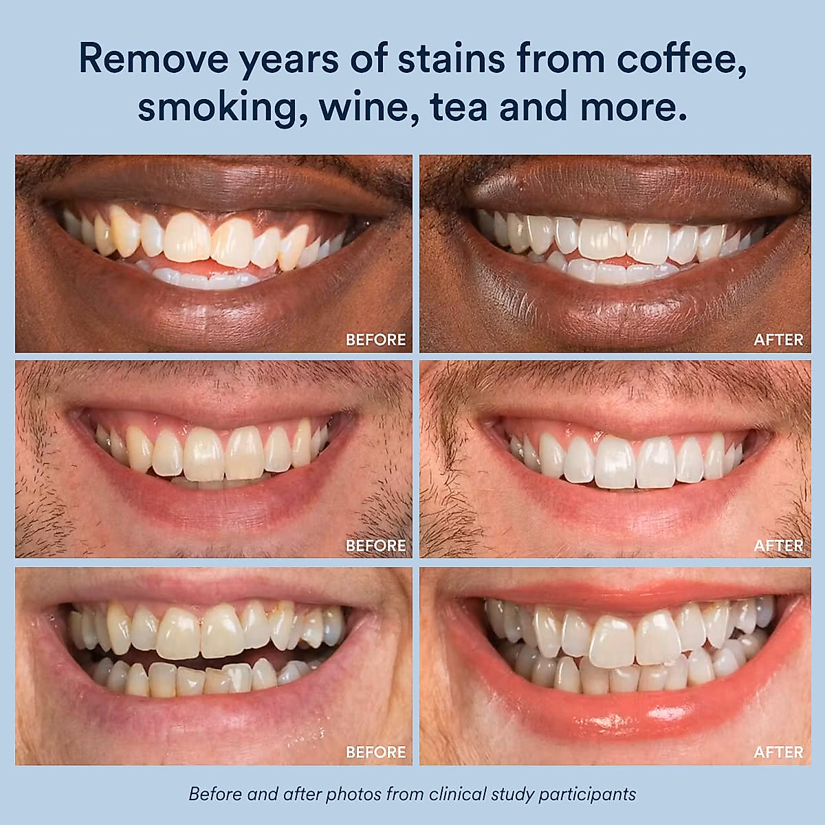 Auraglow Teeth Whitening Kit, LED Accelerator Light, 35% Carbamide Peroxide Teeth Whitening Gel, 20+ Whitening Treatments, 5mL Whitening Gel Syringes, Whiten Teeth Faster