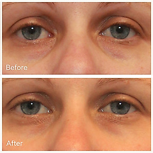 Murad Vita-C Eyes Dark Circle Corrector – Environmental Shield Vitamin C Brightening Serum – Anti-Aging Treatment for Puffiness and Wrinkles, 0.5 Fl Oz