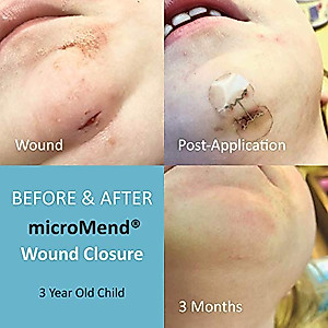 microMend Emergency Wound Closures Surgical Quality Laceration Repair Without Stitches - Think Ahead - Be Prepared- (Kit - 2 microMend Medium Devices, Gauze, Antiseptic Wipe)