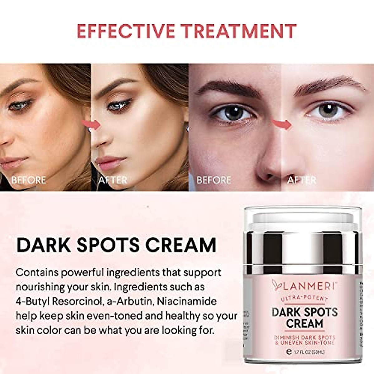 Lanmeri Dark Spot Remover for Face and Body, Dark Spot Corrector Fade Cream, Age Spot, Brown Spot, Sun Spot & Freckle Remover for Face, Hands and Other Body Areas, for Both Women and Men, for All Skin Types