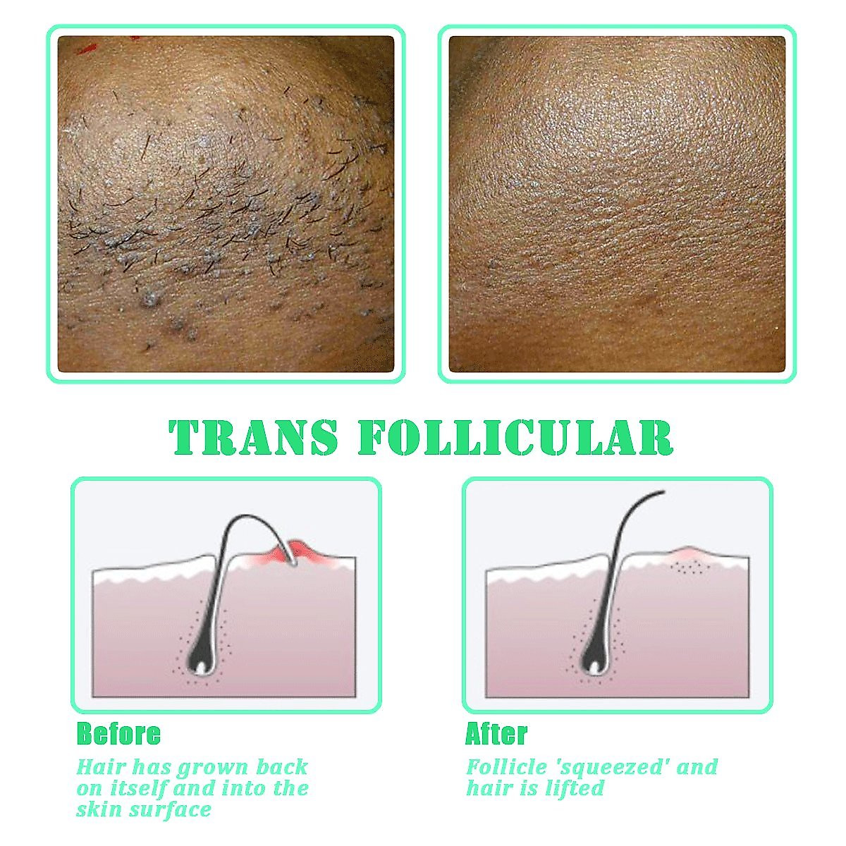 TailaiMei Exfoliating Brush for Ingrown Hair Treatment - To Treat and Prevent Bikini Bumps, Razor Bumps - Silky Smooth Skin Solution for Men and Women