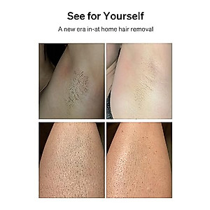 Ulike Laser Hair Removal for Women and Men, Air 3 IPL Hair Removal with Sapphire Ice-Cooling System for Nearly Painless & Long-Lasting Result, Flat-Head Window for Body & Face at-Home Use