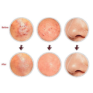 1Set(3PCS) Silver Professional Remove Blackheads Tweezers Set - Stainless Steel Straight/Slanted & Pointed Splinter/Bend Curved Blemish Extractor Tool for Acne Zit Cystic Blemish Whitehead Popping