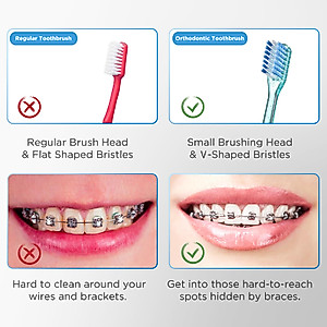 Fregum V-Shaped Orthodontic Toothbrush for Braces, with 6 Interdental Brushes, Soft Bristles, 6 Count