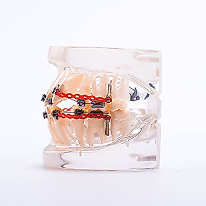 Easyinsmile Dental Orthodontic Treatment Model Teeth/Tooth/Denture Model with Braces for Dentist Studying Researching and Patient Education (Metal Bracket)