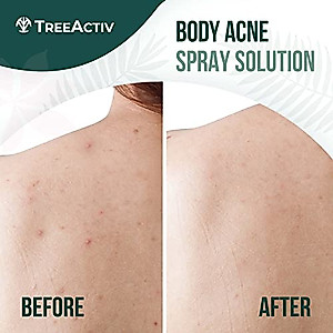 TreeActiv Salicylic Acid Back & Body Acne Spray - 2% Salicylic Acid Spray for Back Acne Solution For Women And Men - Back Acne Treatment Organic For Body That Prevents & Shrinks Body Acne - 4oz 2-pack