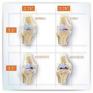 GPI Anatomicals Knee Joint Model Set | Human Body Anatomy Replica Set of 4-Stage Osteoarthritis Knee Joint for Doctors Office Educational Tool