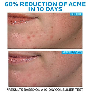 La Roche-Posay Effaclar Duo Dual Action Acne Spot Treatment Cream with Benzoyl Peroxide Acne Treatment, Blemish Cream for Acne and Blackheads, Safe For Sensitive Skin, 1.35 Fl Oz (Pack of 1)