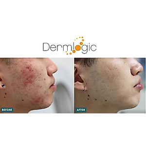 Acne Treatment Pads- Contains Salicylic, Glycolic, & Lactic Acid for Face & Body. Clears Away Clogged Pores, Oily Skin & Cystic Breakouts. Removes Dark Spots, Blackhead & Whitehead Pimples