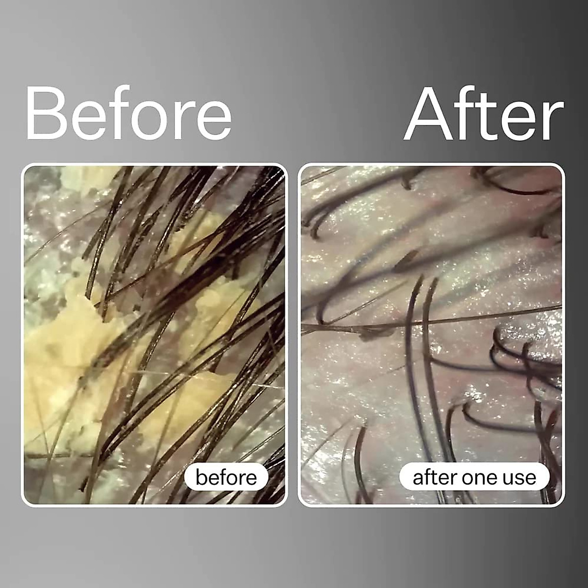 ACT+ ACRE Cold Processed Balancing Shampoo - Clarifying Cleanse for Build Up - Sulfate Free Gentle Hair Treatment with Moringa Oil - Moisturize and Strengthen Damaged Hair (10 Fl.oz)