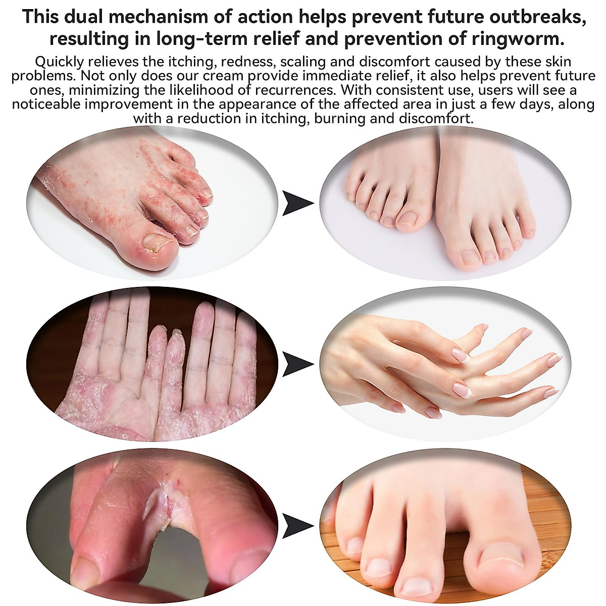 Heat Rash Itch Relief, Extra Strength Cream, Jock Itch, Athlete's Foot Hand Skin, Tinea Versicolor, Armpit, Itchy Feet, Psoriasis, Scalp Dandruff, Fast Relief for Eczema, Rosacea, 24h Soothing Treat